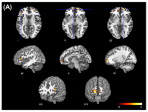 Brain on Cocaine – Recovery Research Institute