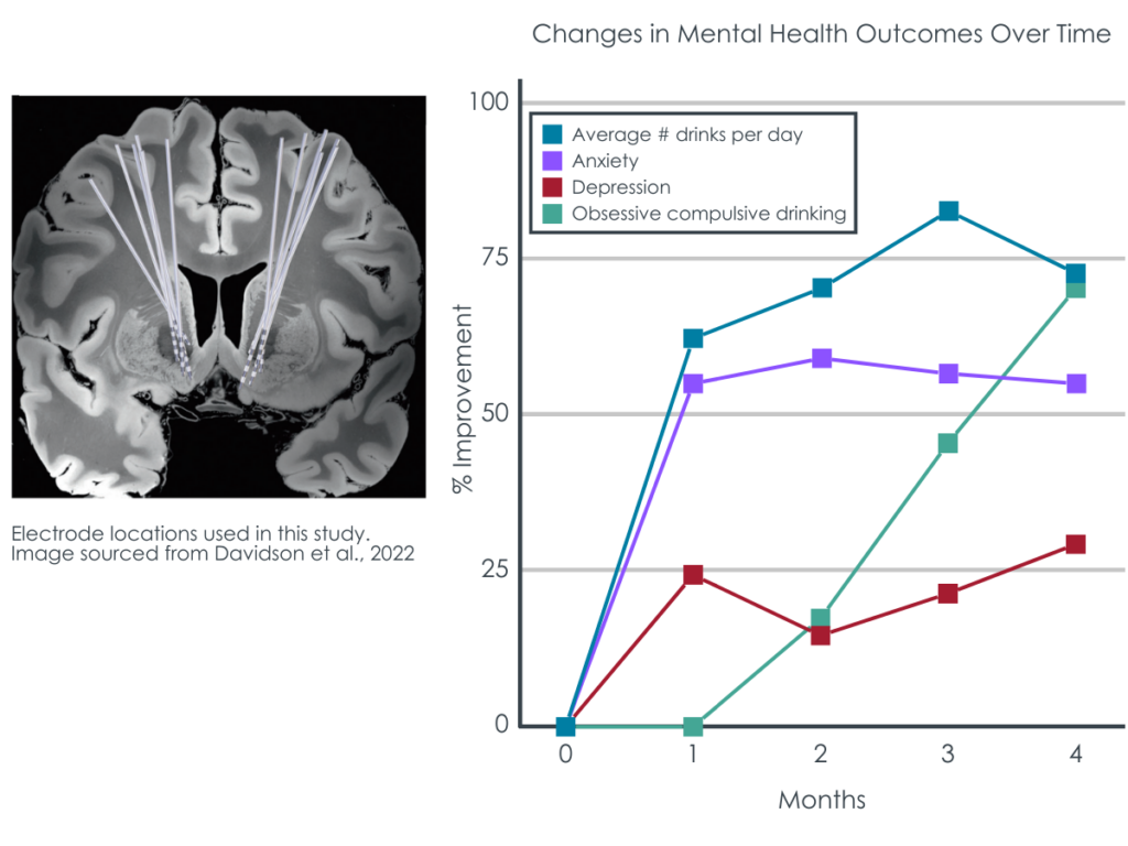 Deep brain stimulation for alcohol use disorder recovery – Recovery ...