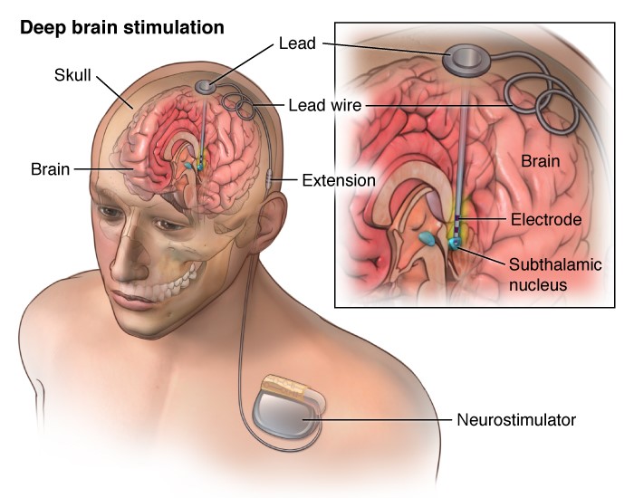 Brain Stimulation As Addiction Treatment Science Fiction Or An Brain Stimulation As Addiction Treatment Science Fiction Or An